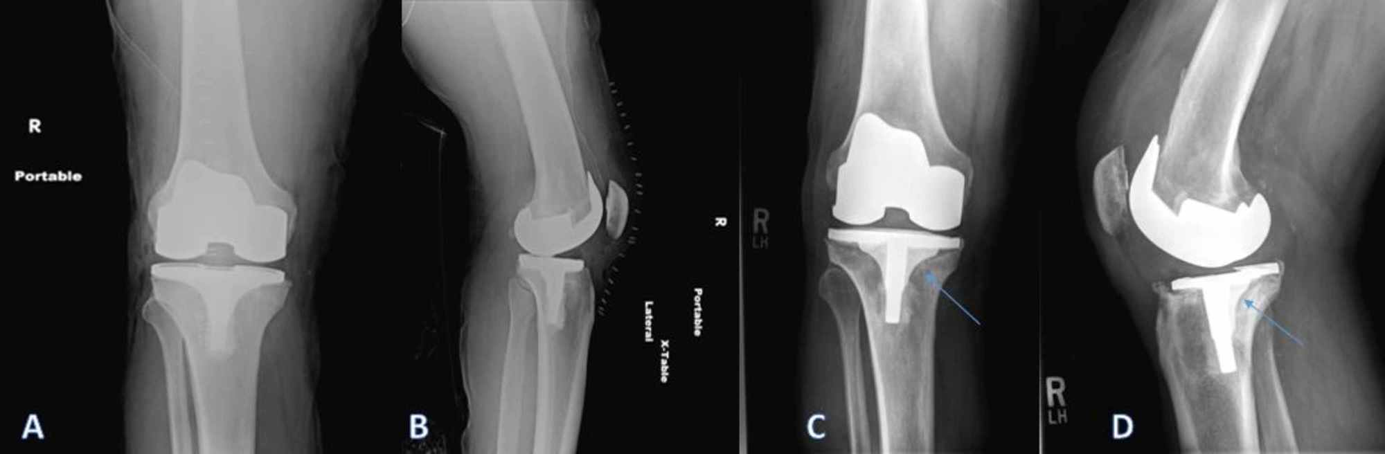 When to get a Total Knee Replacement (TKR) · DM Physiotherapy Australia ...